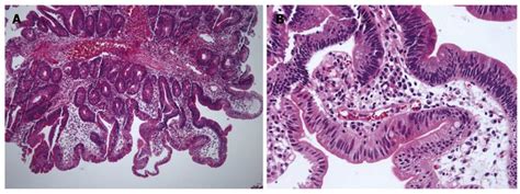 Evaluation Of Non Ampullary Duodenal Polyps Comparison Of Non Neoplastic And Neoplastic Lesions