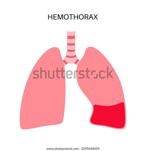 Hemothorax Diseaseblood Collects Pleural Cavity Lungs Stock Vector