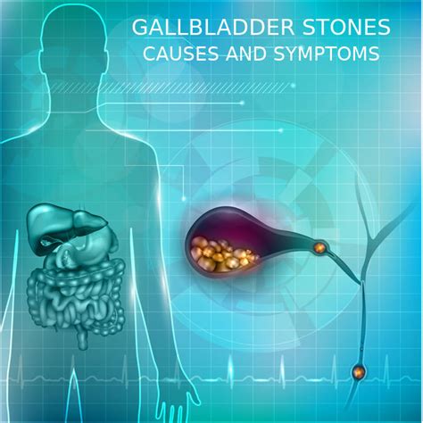 Gallbaldder Stones Causes And Symptoms Medfin