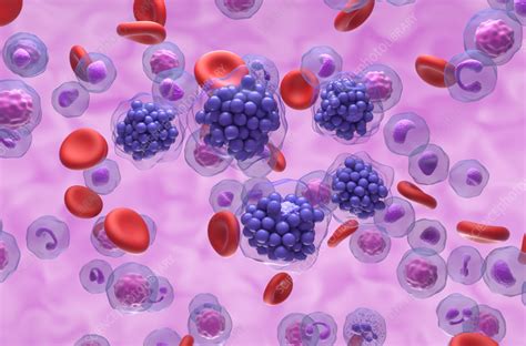 Diffuse Large B Cell Lymphoma Illustration Stock Image F042 8171
