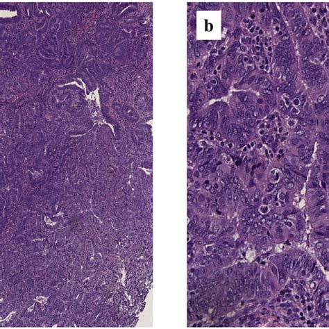 Hysteroscopy Found No Obvious Proliferative Lesion In The Patients Uterus Download