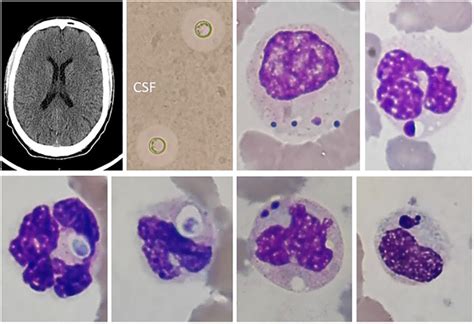 Cryptococcus Neoformans In Cerebrospinal Fluid And Blood Pmc Cryptococcus Neoformans In Cerebrospinal Fluid And Blood Pmc