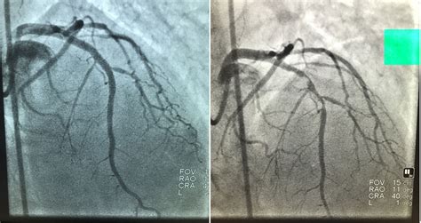 Best Coronary Angioplasty Doctor In Kolkata Coronary Angiogram And Angioplasty Treatment In