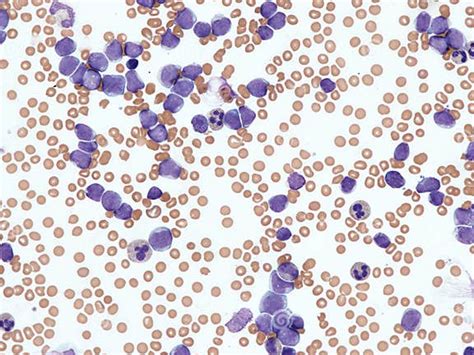 Leucemia Linfoide Aguda Transplante Foto De Stock Imagem De Sangue