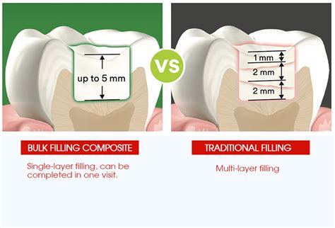 understanding bulk filling composite solutions for common dental