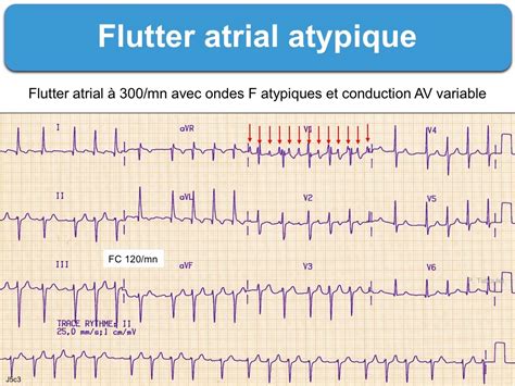 Flutter Atrial 1 Ecg E Cardiogram