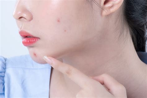 여드름 약과 같이 먹으면 안 되는 약 총정리 닥터나우