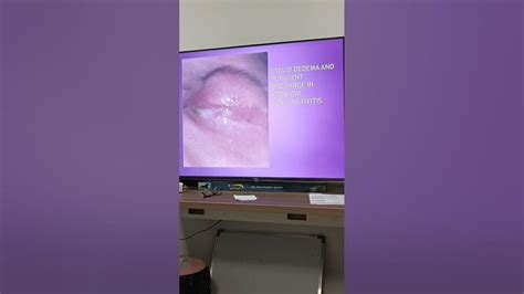 Conjunctival Diseases Part 2 By Drfarooq Mohammed Alsaad Youtube