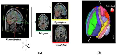 Multimodal Stereotactic Brain Tumor Segmentation Using 3d Znet