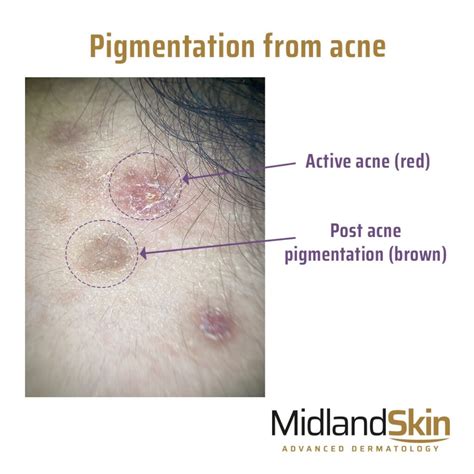 Acne Pigmentation Treatment In Birmingham By Dermatologists