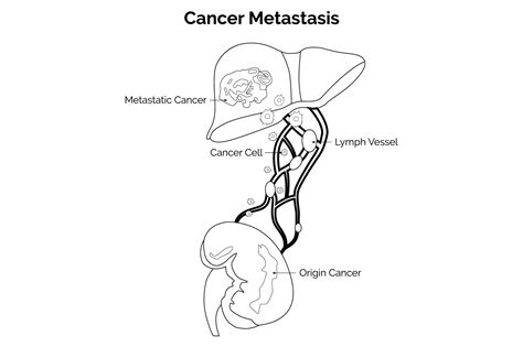 Cancer Metastasis Science Design Vector Graphic By Hamjaiu · Creative