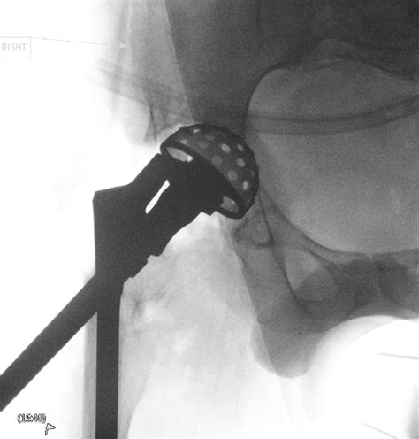Revision Total Hip Arthroplasty Using A Direct Anterior Approach In A Patient With