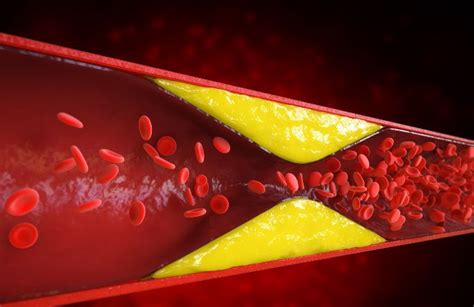 Intervento Di Bypass In Cosa Consiste E A Cosa Serve