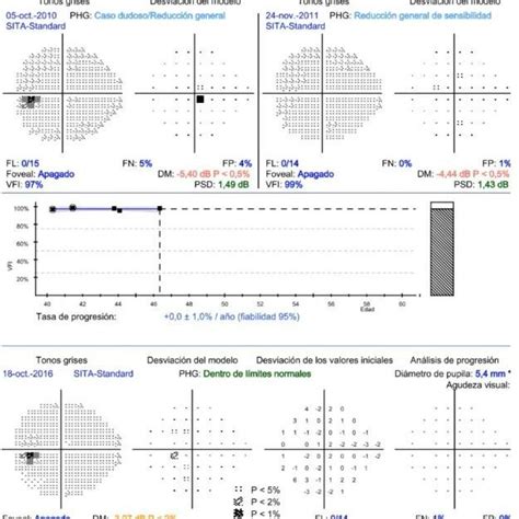 A B Visual Field 24 2 Stability Of The VFI In The Glaucoma Progression Download Scientific