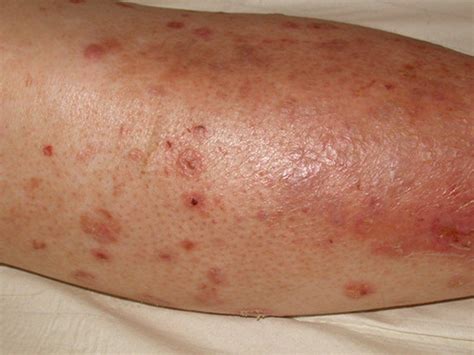 Diabetic Dermopathy Pictures Symptoms Treatment Causes