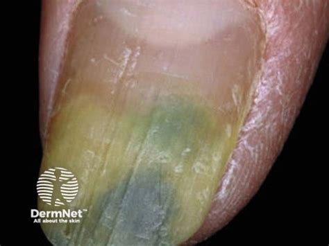 Pseudomonas Infections Symptoms Causes And Treatments