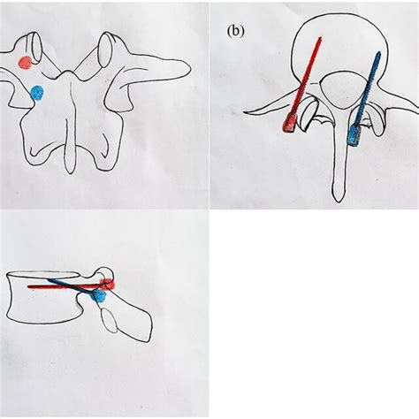 Diagrams Of Starting Points Of Pedicle Screw Red Circle And Cbt Screw Download Scientific