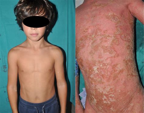 30 Facts About Interleukin 36 Receptor Antagonist Deficiency Ditra