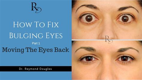Bulging Eyes