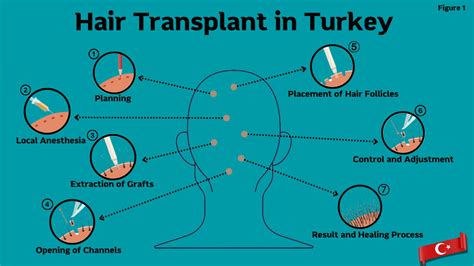 Hair Transplant In Turkey Hair Transplant 2026 Costs