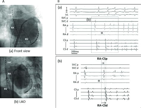 Catheter Position And Intra Cardiac Electrograms Of Af Initiation By A Download Scientific