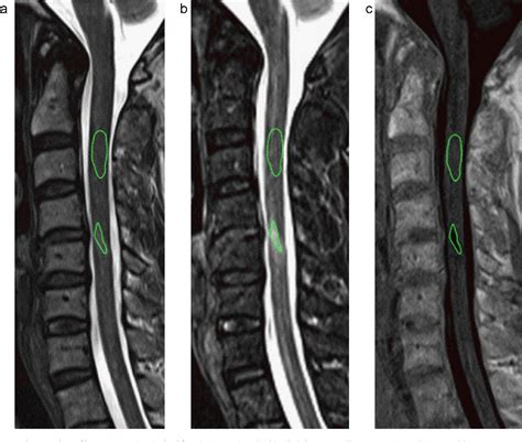 Figure 1 From Comparison Of Mri Sequences For Evaluation Of Multiple