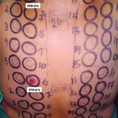 A Group 3 Case 4 Positive Patch Test Reactions From Paraphenylene Download Scientific