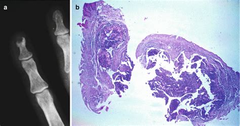 Glomus Tumor Musculoskeletal Key
