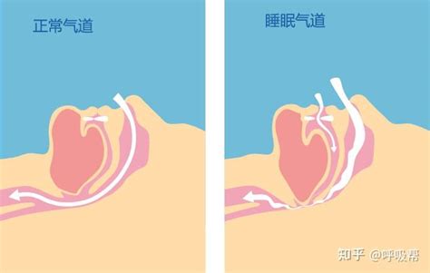 什么样的人容易打呼噜打鼾的人请对号入座 知乎