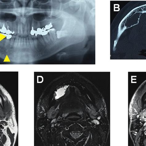 Pdf Aneurysmal Bone Cyst In The Mandible Report Of 2 Cases And
