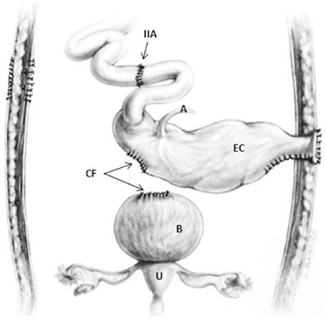 Rescue Operation Consisting Of Ileostomy Closure Ligation Of The