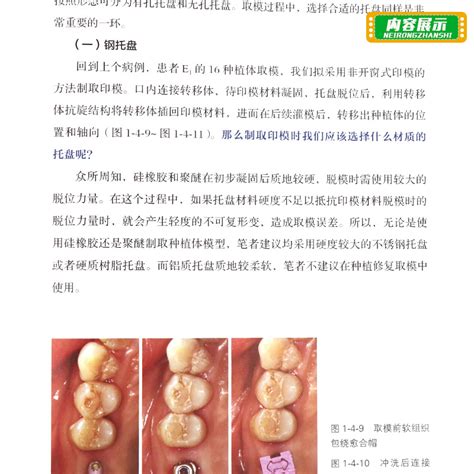 人卫正版口腔种植的精准植入技巧满毅二期手术和取模技巧2本满毅手术学图解前后牙全口义齿拔牙假牙修复主治医师人民卫生出版书籍 虎窝淘