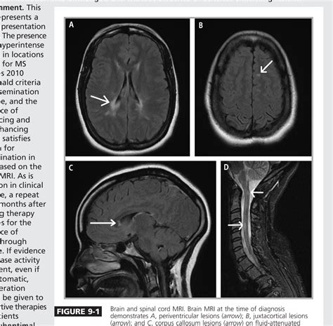 Explain Multiple Sclerosis Brain Mri