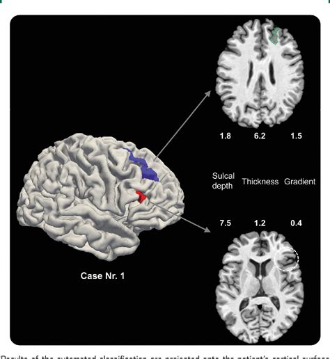 Figure 3 From Automated Detection Of Cortical Dysplasia Type Ii In Mri Negative Epilepsy
