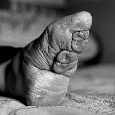 Foot Binding Infections