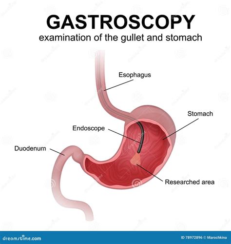 Gastroscopy Procedure Egd Stock Vector Illustration Of Digestive