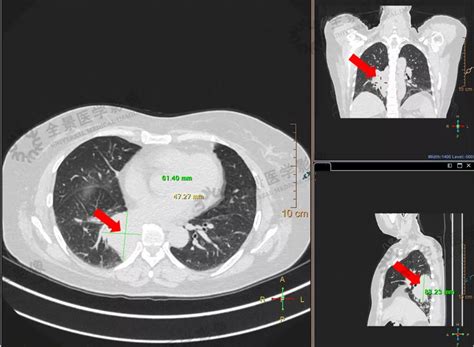 PET CT MR异机融合 影像检查 全景医学影像