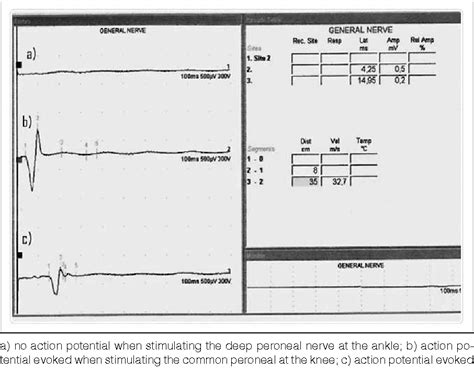 Accessory Deep Peroneal Nerve Semantic Scholar