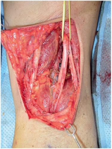 Neck Axillary Ilioinguinal And Other Lymph Node Dissections