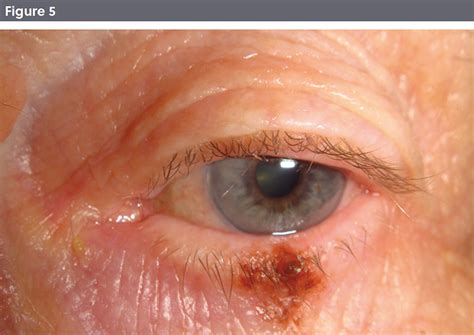 Eyelid Lesions All You Need To Know