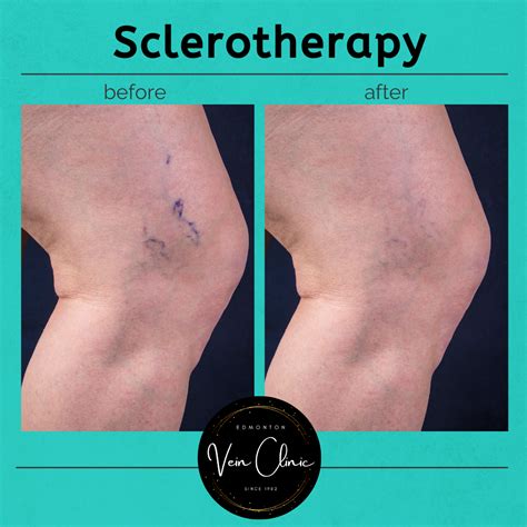 Sclerotherapy For Varicose And Spider Vein Treatment Edmonton Vein Clinic