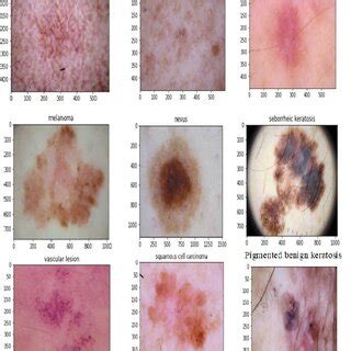 Skin Lesion Types Below Points Provides A Brief Explanation About The