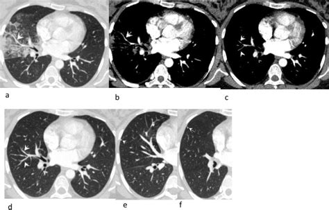 Parenchymal Opacities Associated With Pulmonary Embolism Respiratory