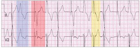 Biventricular Pacing