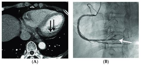 False Negative Diagnosis Of Acute Myocardial Infarction On Non Gated