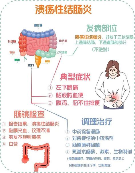 一张图彻底看懂溃疡性结肠炎！