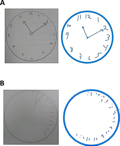 Clock Drawing Test Examples At Isaac Rivera Blog