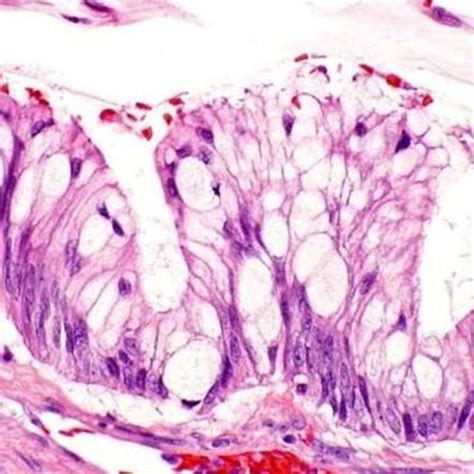 Microscopic Appearance X400 Epithelial Coating With Tendency To