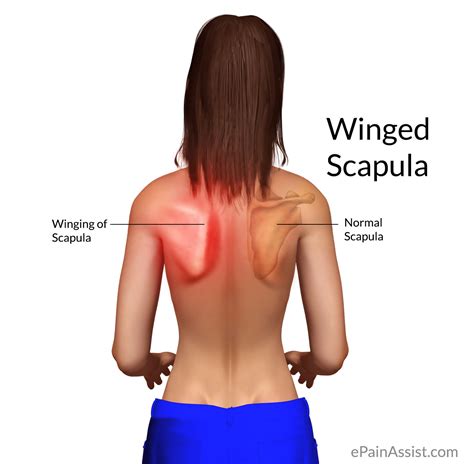 Winged Scapula Or Scapular Wingingcausessymptomstreatmentexercise