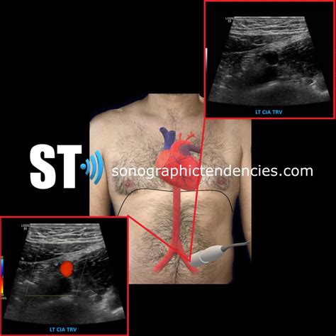 Aorta Duplex Doppler Protocol Sonographic Tendencies